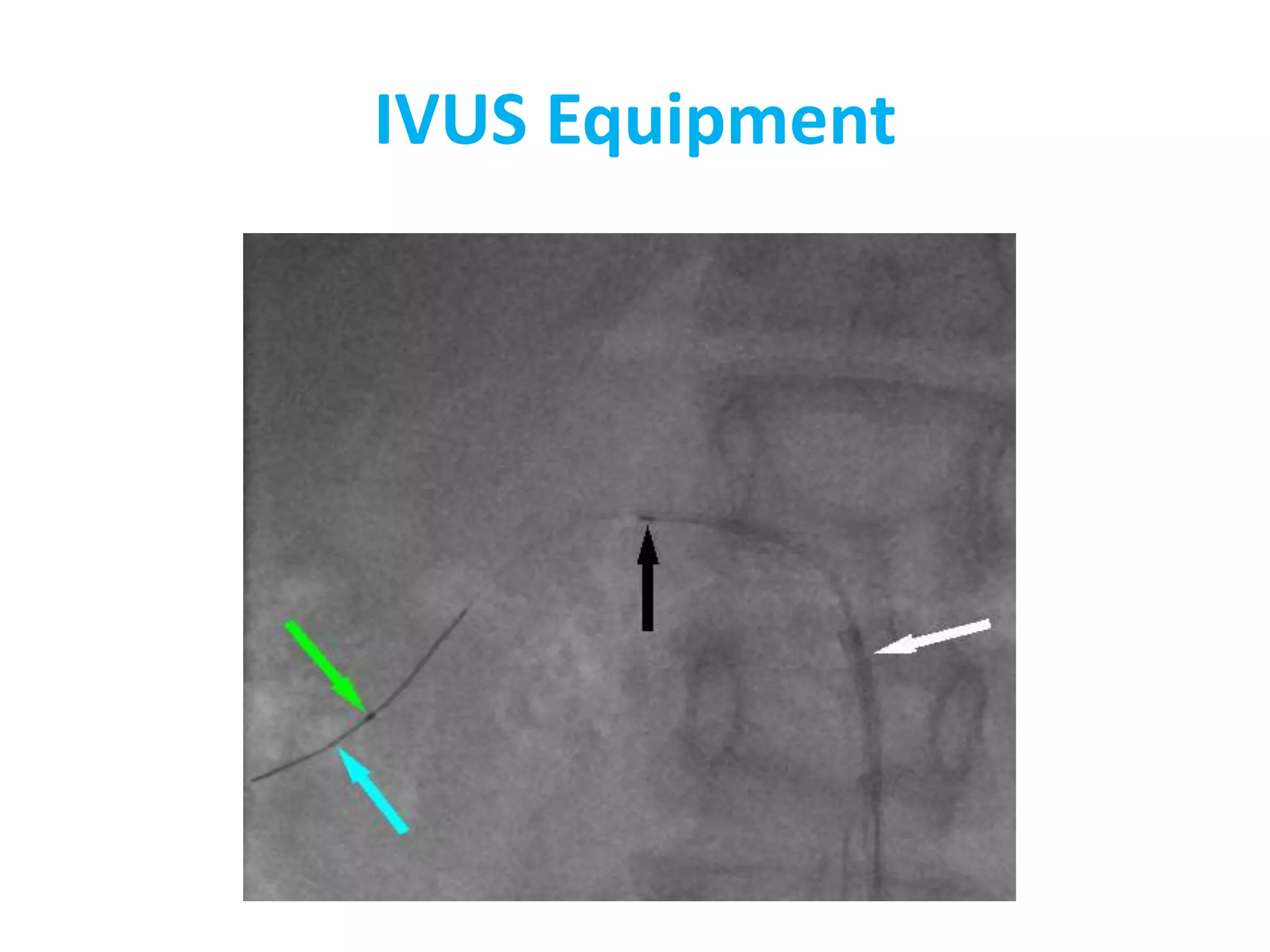 Ivus | PPTX