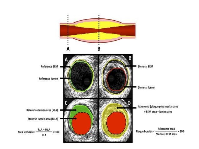 Ivus | PPTX | Heart and Cardiovascular Diseases | Diseases and Conditions