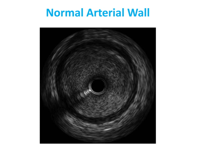 Ivus | PPTX | Heart and Cardiovascular Diseases | Diseases and Conditions
