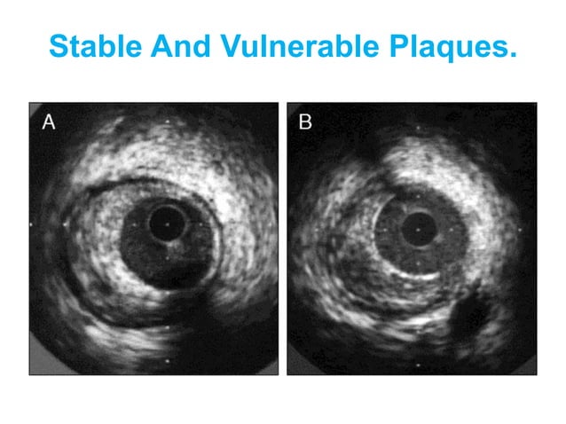 Ivus | PPTX | Heart and Cardiovascular Diseases | Diseases and Conditions