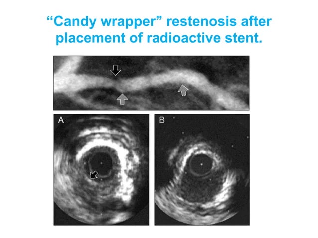 Ivus | PPTX | Heart and Cardiovascular Diseases | Diseases and Conditions