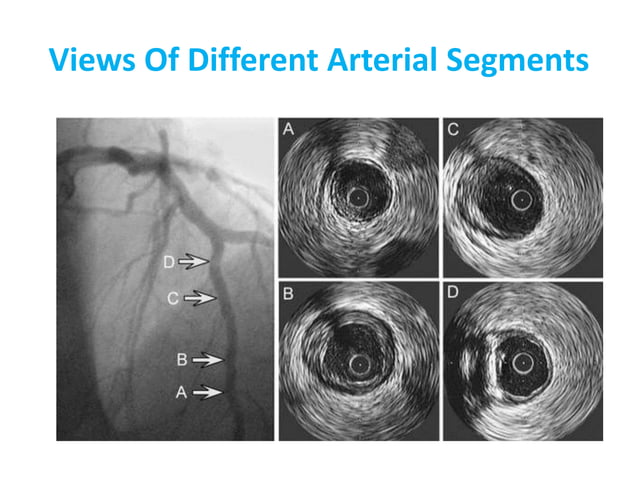 Ivus | PPTX | Heart and Cardiovascular Diseases | Diseases and Conditions