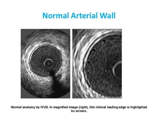 IVUS | PPTX | Heart and Cardiovascular Diseases | Diseases and Conditions