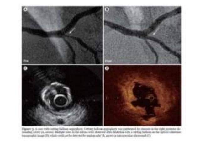 IVUS | PPTX | Heart and Cardiovascular Diseases | Diseases and Conditions