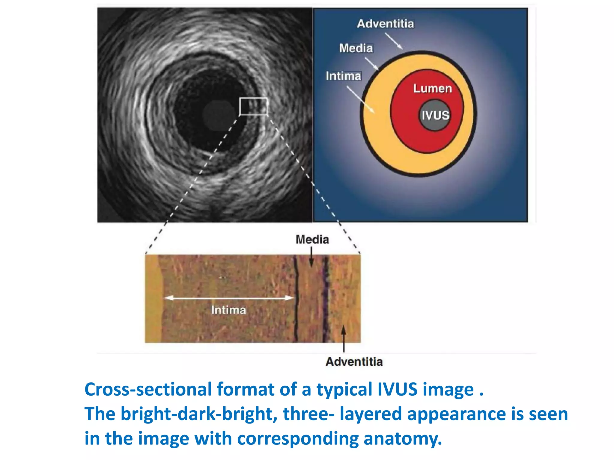 Intravascular Ultrasound (IVUS) | PPTX