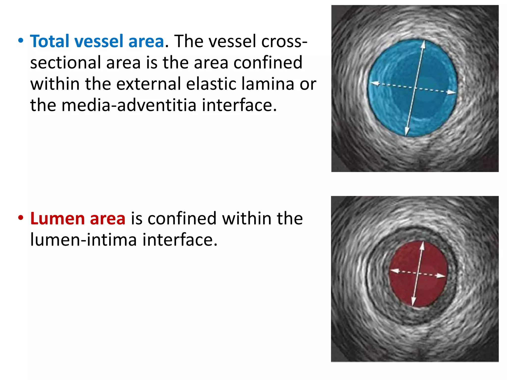 Intravascular Ultrasound (IVUS) | PPTX