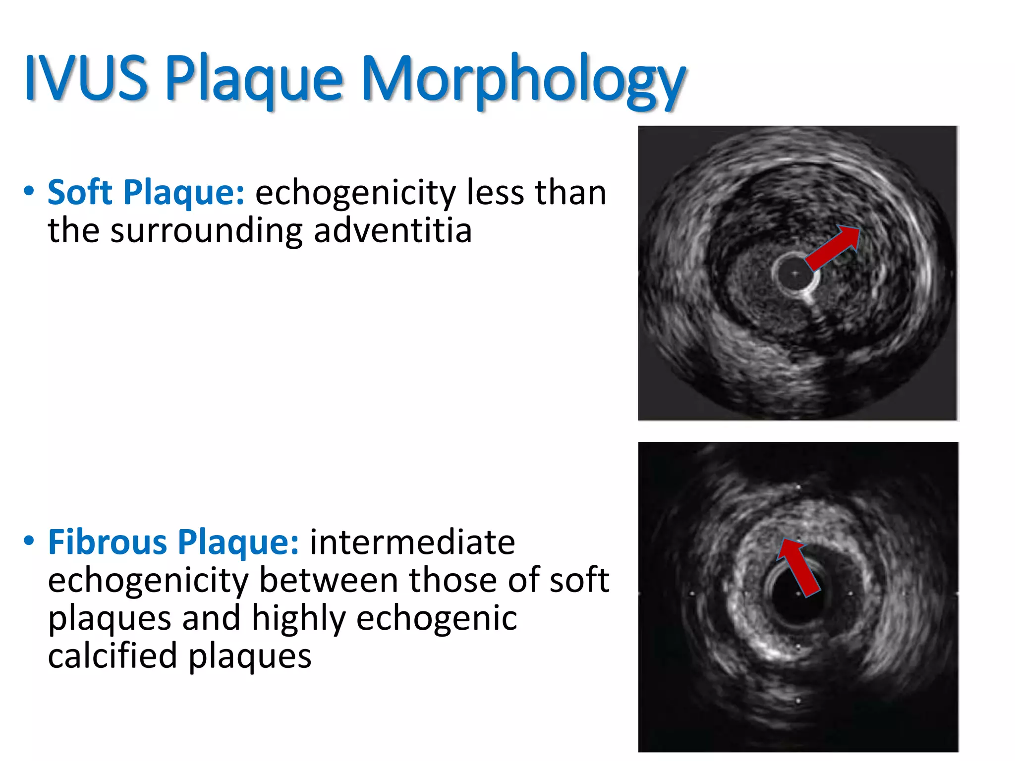 Intravascular Ultrasound (IVUS) | PPTX