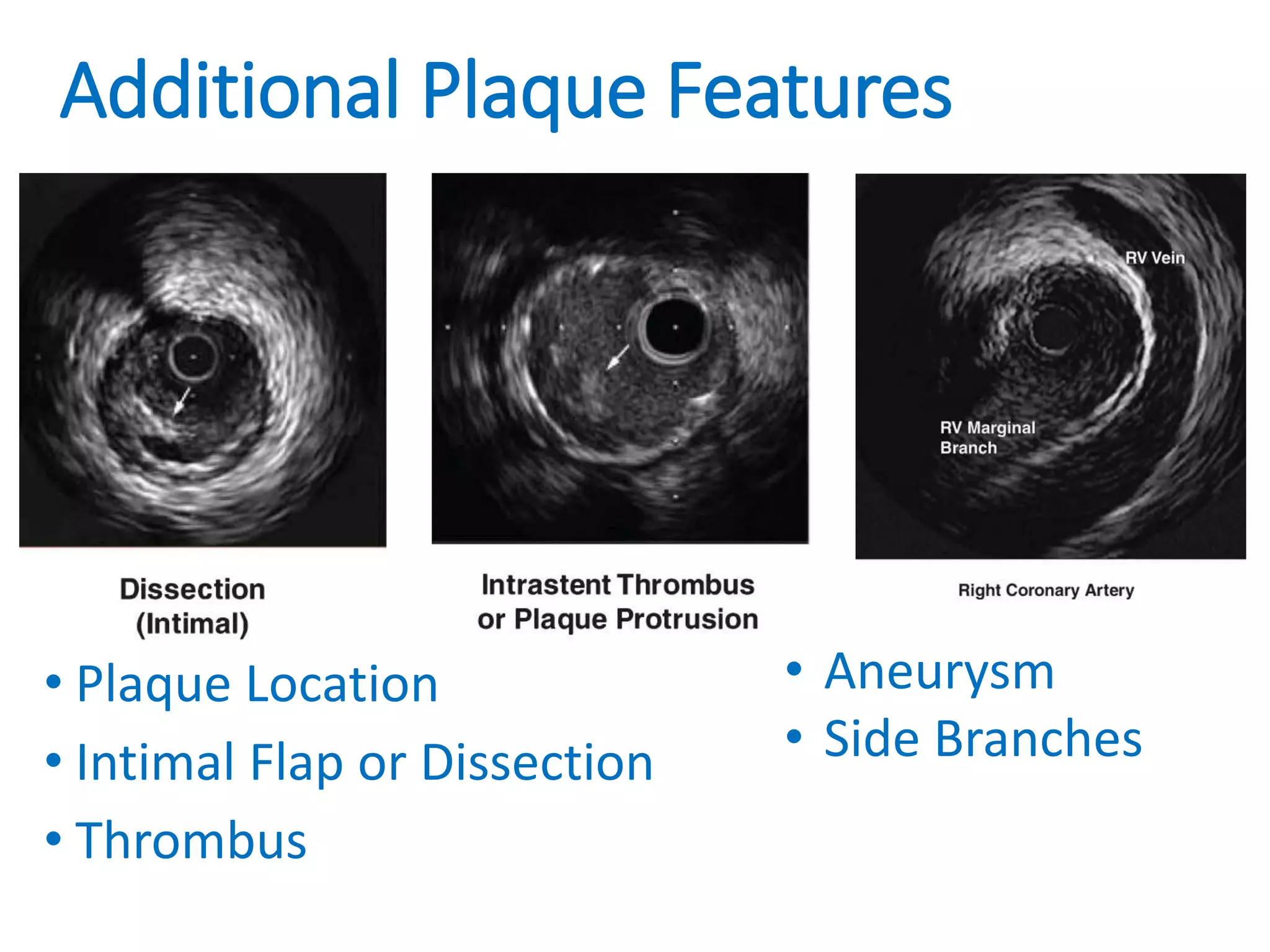 Intravascular Ultrasound (IVUS) | PPTX