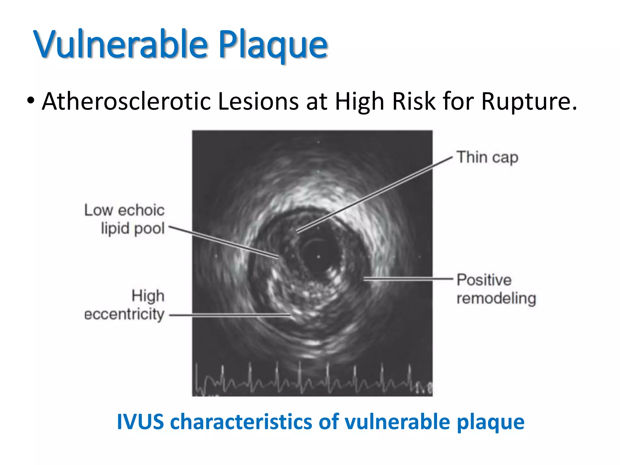 Intravascular Ultrasound (IVUS) | PPTX