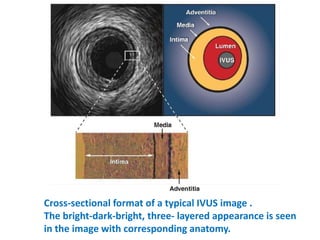 Intravascular Ultrasound (IVUS) | PPTX