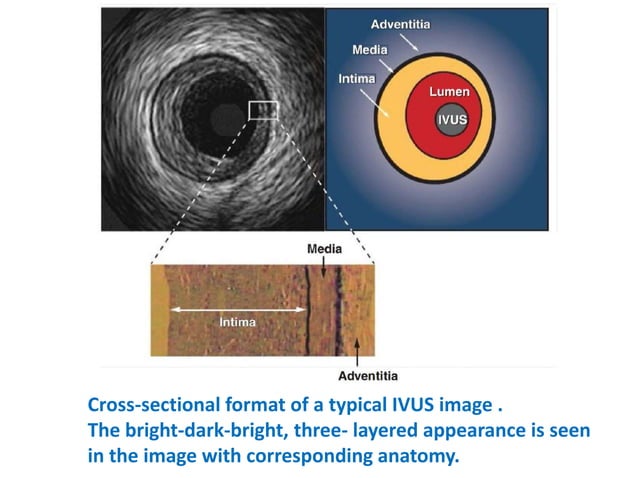 Intravascular Ultrasound (IVUS) | PPTX | Heart and Cardiovascular ...