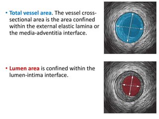 Intravascular Ultrasound (IVUS) | PPTX