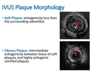 Intravascular Ultrasound (IVUS) | PPTX