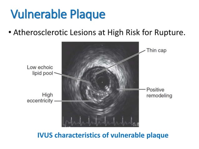 Intravascular Ultrasound (IVUS) | PPTX | Heart and Cardiovascular ...