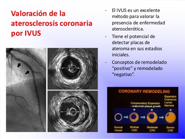 IVUS y OCT: Técnicas de Diagnóstico Intracoronario