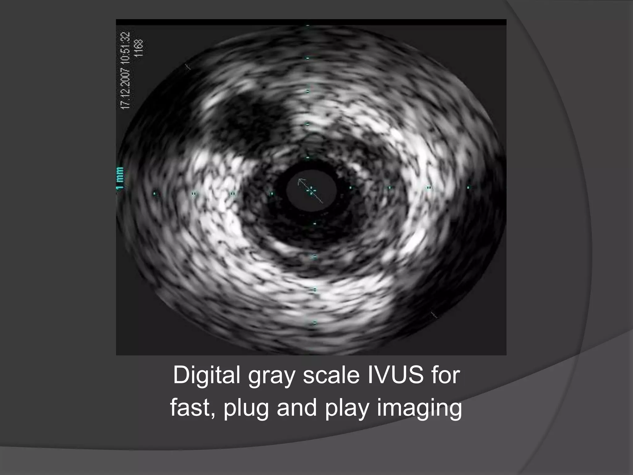 IVUS | PPTX