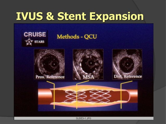 IVUS | PPTX | Heart and Cardiovascular Diseases | Diseases and Conditions