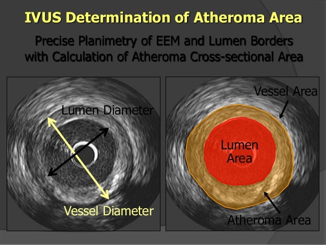 Ivus