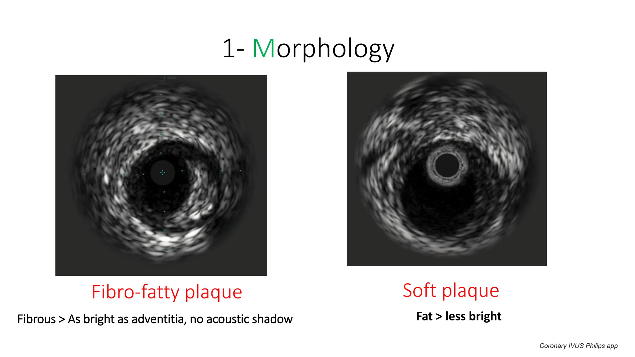 IVUS Intravascular ultrasound made easy for intervention cardiologist | PDF