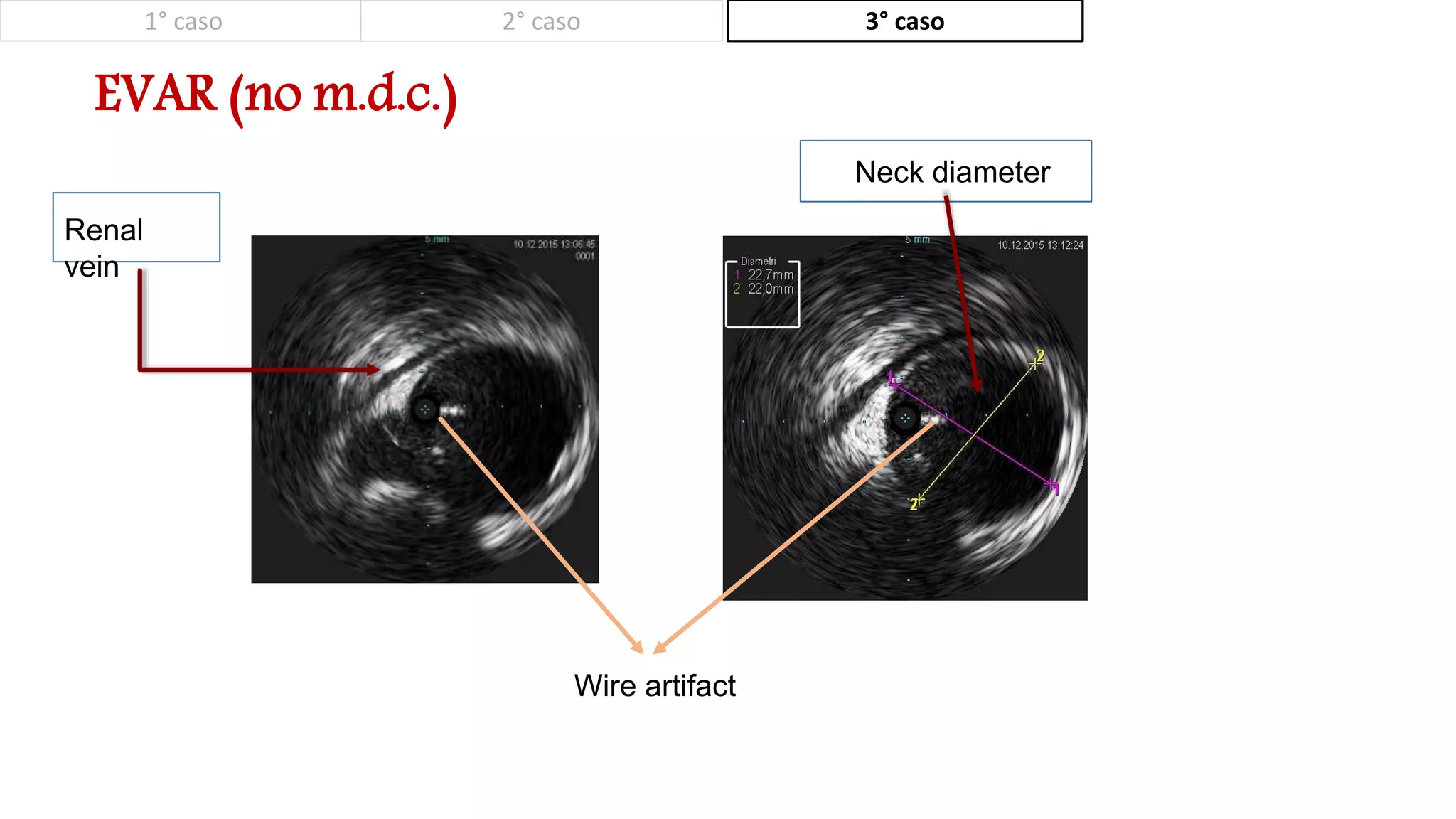 Ivus evar | PPTX
