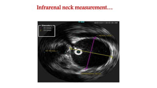 Ivus evar | PPTX