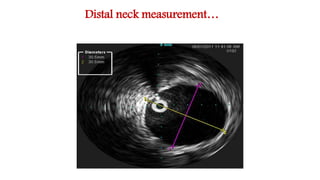 Ivus evar | PPTX