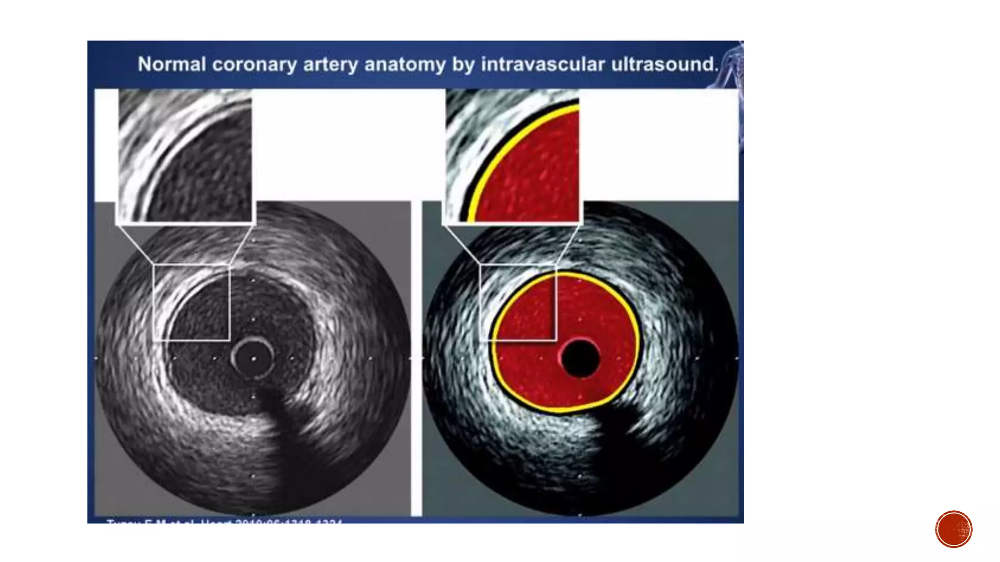 Ivus jc ultimate trial | PPTX