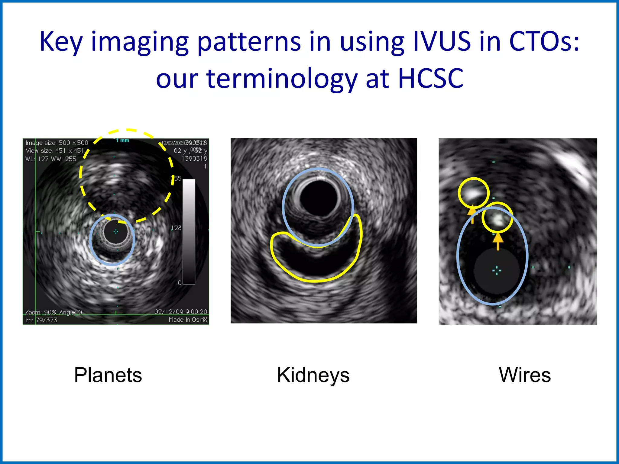 Philip Dingli. Javier Escaned - Intracoronary imaging in CTOs When to ...