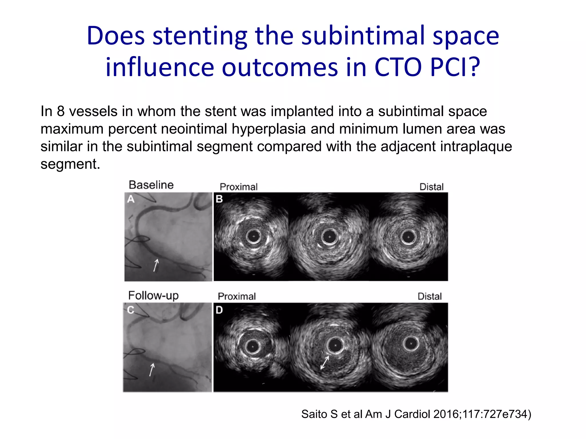 Philip Dingli. Javier Escaned - Intracoronary imaging in CTOs When to ...
