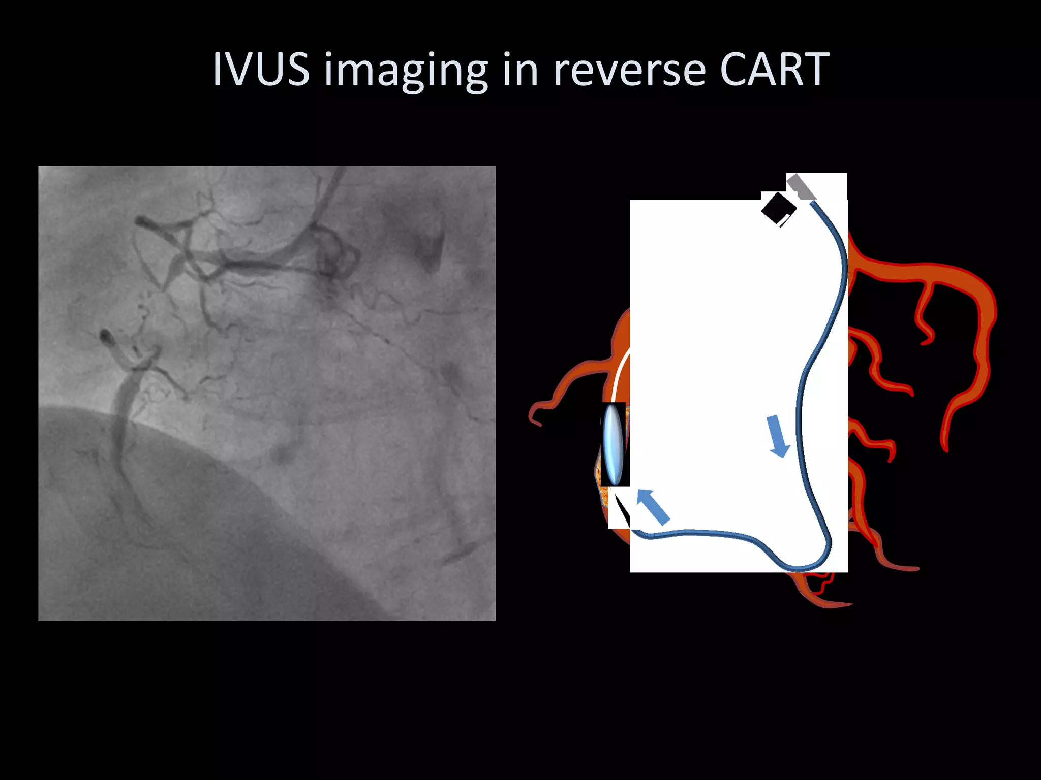 Philip Dingli. Javier Escaned - Intracoronary imaging in CTOs When to ...