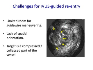 Philip Dingli. Javier Escaned - Intracoronary imaging in CTOs When to ...