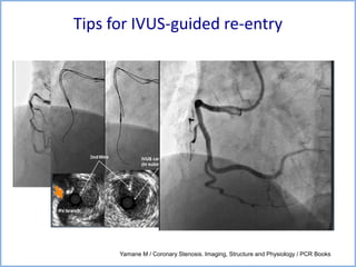 Philip Dingli. Javier Escaned - Intracoronary imaging in CTOs When to ...