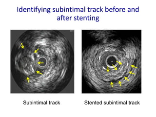 Philip Dingli. Javier Escaned - Intracoronary imaging in CTOs When to ...