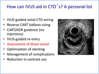 Philip Dingli. Javier Escaned - Intracoronary imaging in CTOs When to ...