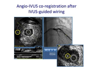 Philip Dingli. Javier Escaned - Intracoronary imaging in CTOs When to ...