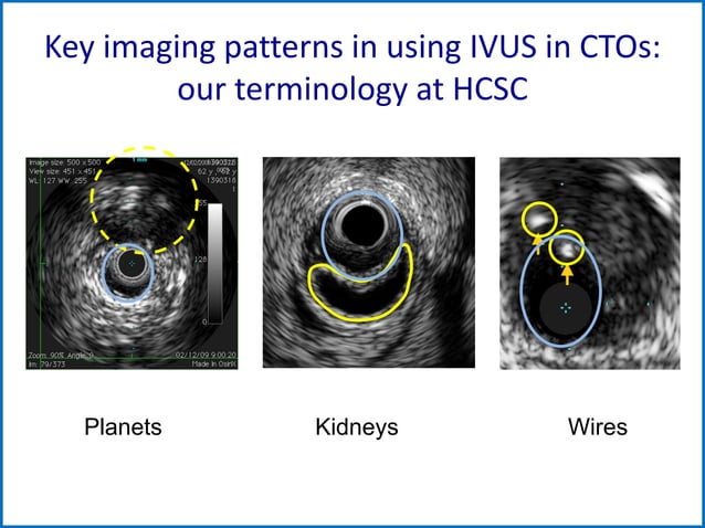 Philip Dingli. Javier Escaned - Intracoronary imaging in CTOs When to ...