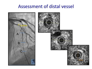 Philip Dingli. Javier Escaned - Intracoronary imaging in CTOs When to ...