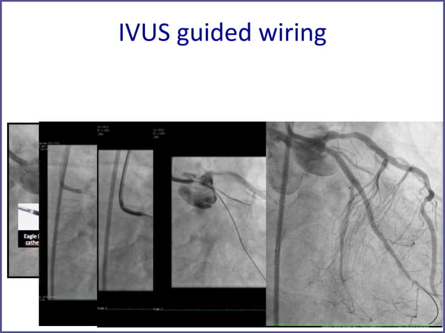 Philip Dingli. Javier Escaned - Intracoronary imaging in CTOs When to ...
