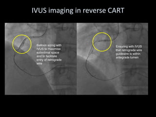Philip Dingli. Javier Escaned - Intracoronary imaging in CTOs When to ...