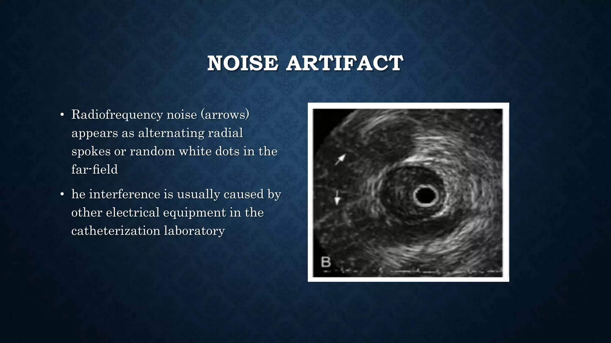 IVUS | PPTX