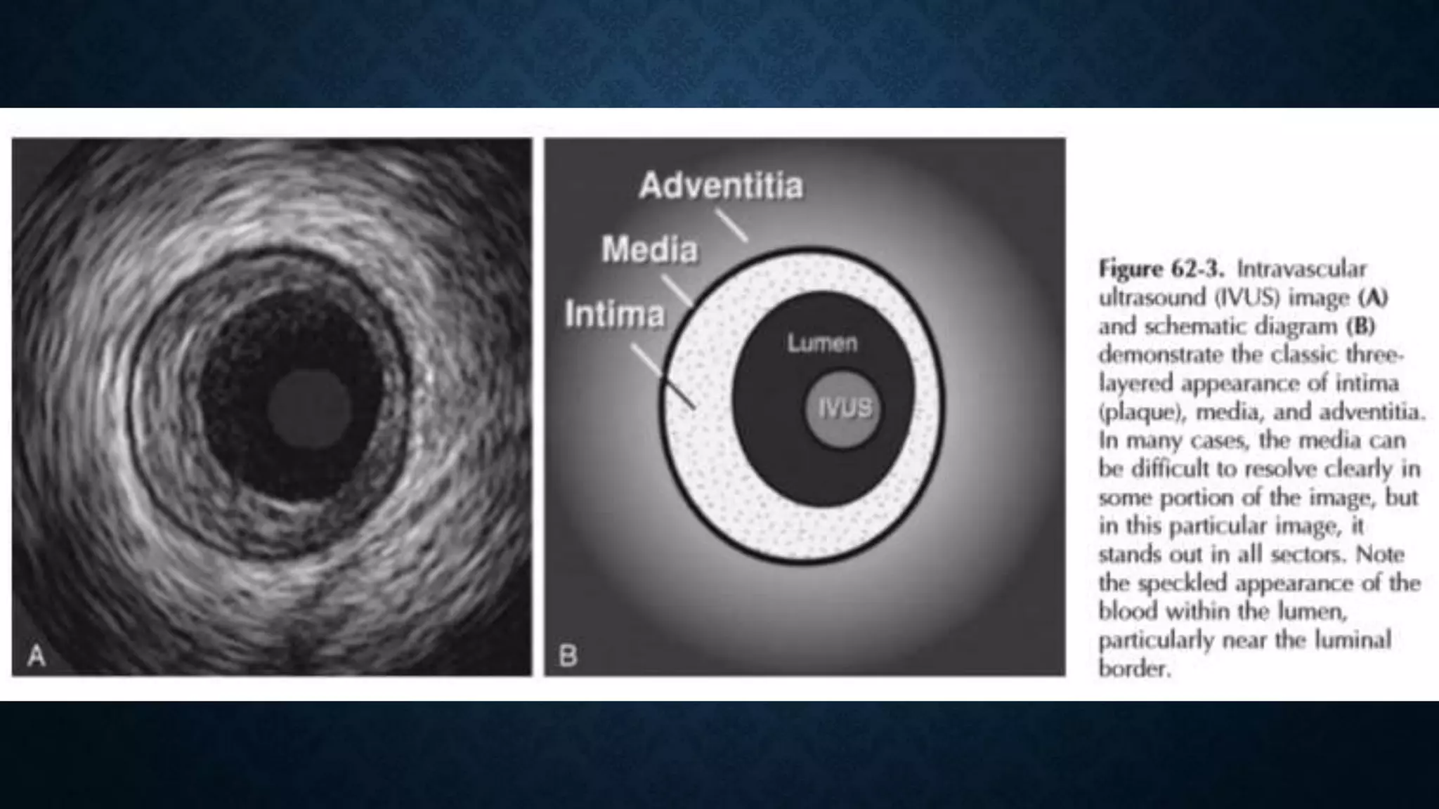 IVUS | PPTX