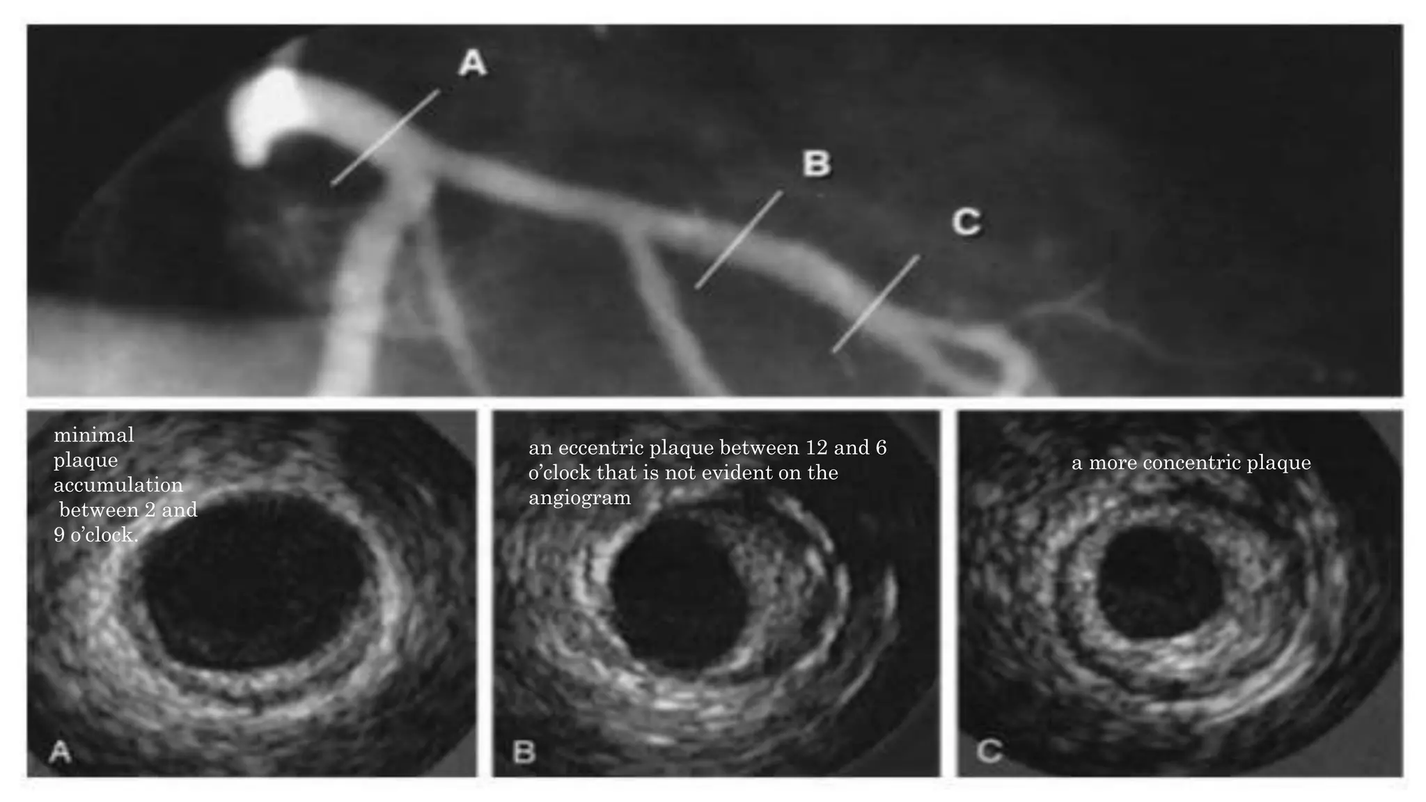 IVUS | PPTX