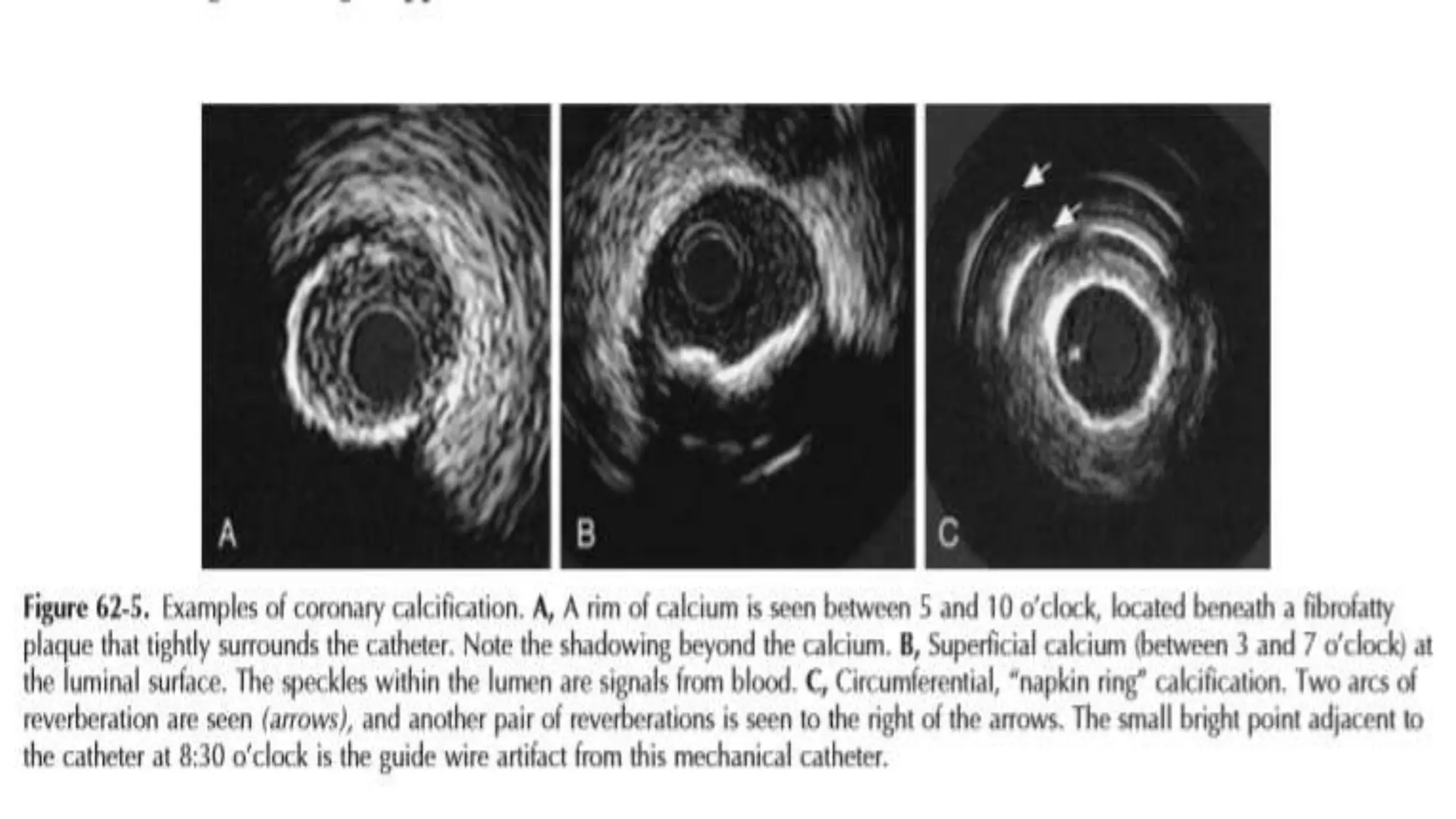 IVUS | PPTX