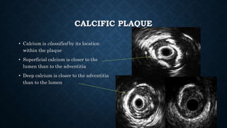 IVUS | PPTX