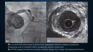 IVUS | PPTX