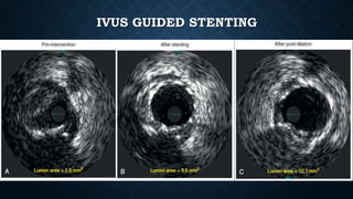 IVUS | PPTX