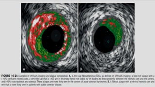 IVUS | PPTX
