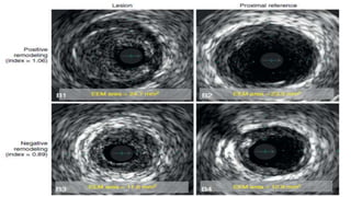 IVUS | PPT