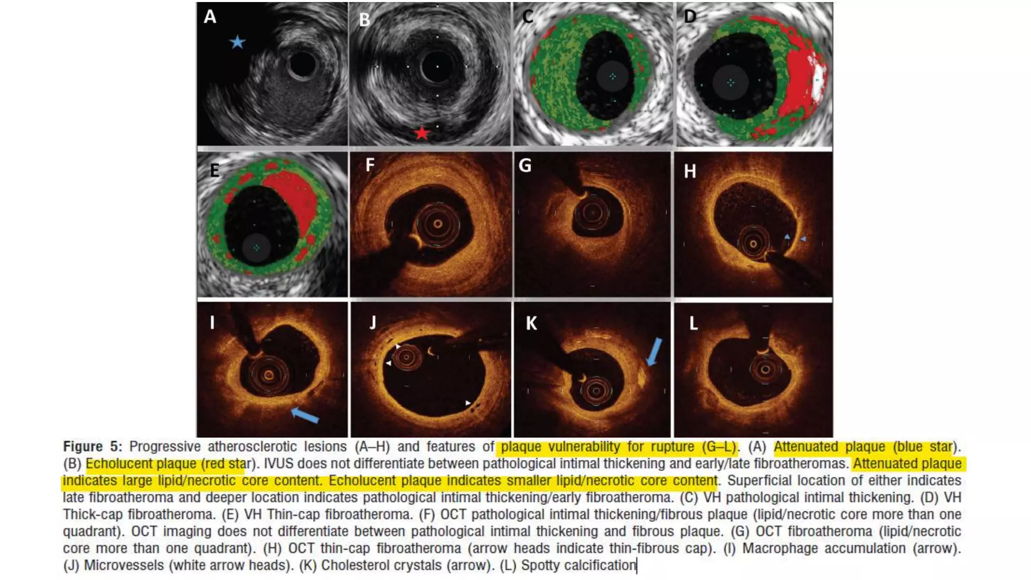 IVUS v/s OCT for Coronary Revascularization | PPTX