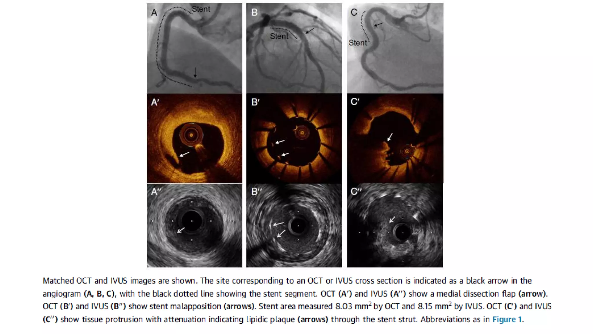 IVUS v/s OCT for Coronary Revascularization | PPTX